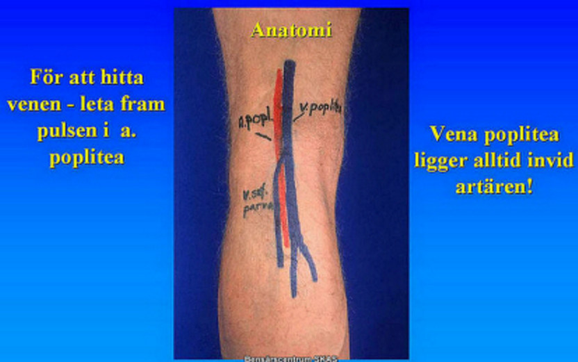 Vena safena parva - Sårwebben